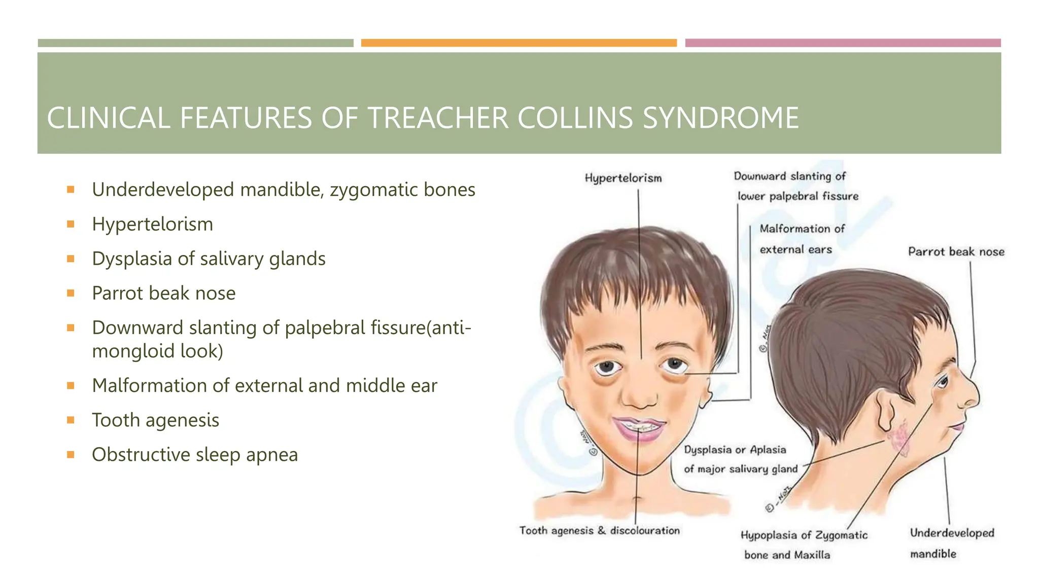 micrognathic syndromes affecting oral cavity | PPTX