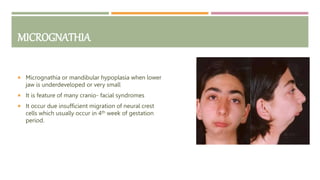 micrognathic syndromes affecting oral cavity | PPTX