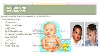micrognathic syndromes affecting oral cavity | PPTX