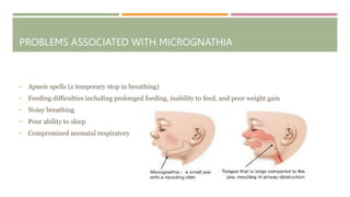 micrognathic syndromes affecting oral cavity | PPTX