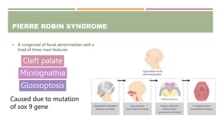 micrognathic syndromes affecting oral cavity | PPTX