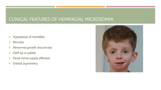 micrognathic syndromes affecting oral cavity | PPTX