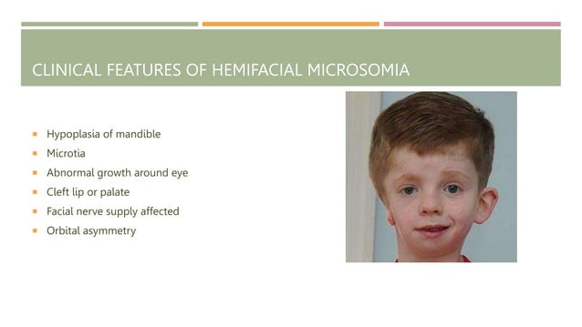micrognathic syndromes affecting oral cavity | PPTX