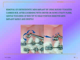 clinical application of microimplants in orthodontics | PPT