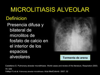 Microlitiasis alveolar | PPT