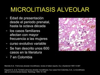 Microlitiasis alveolar | PPT