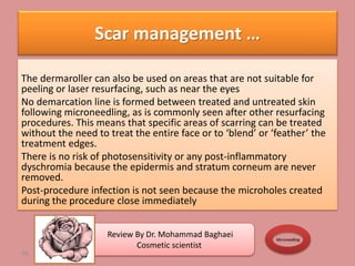 Microneedling, A brief review by Dr. Mohammad Baghaei | PDF