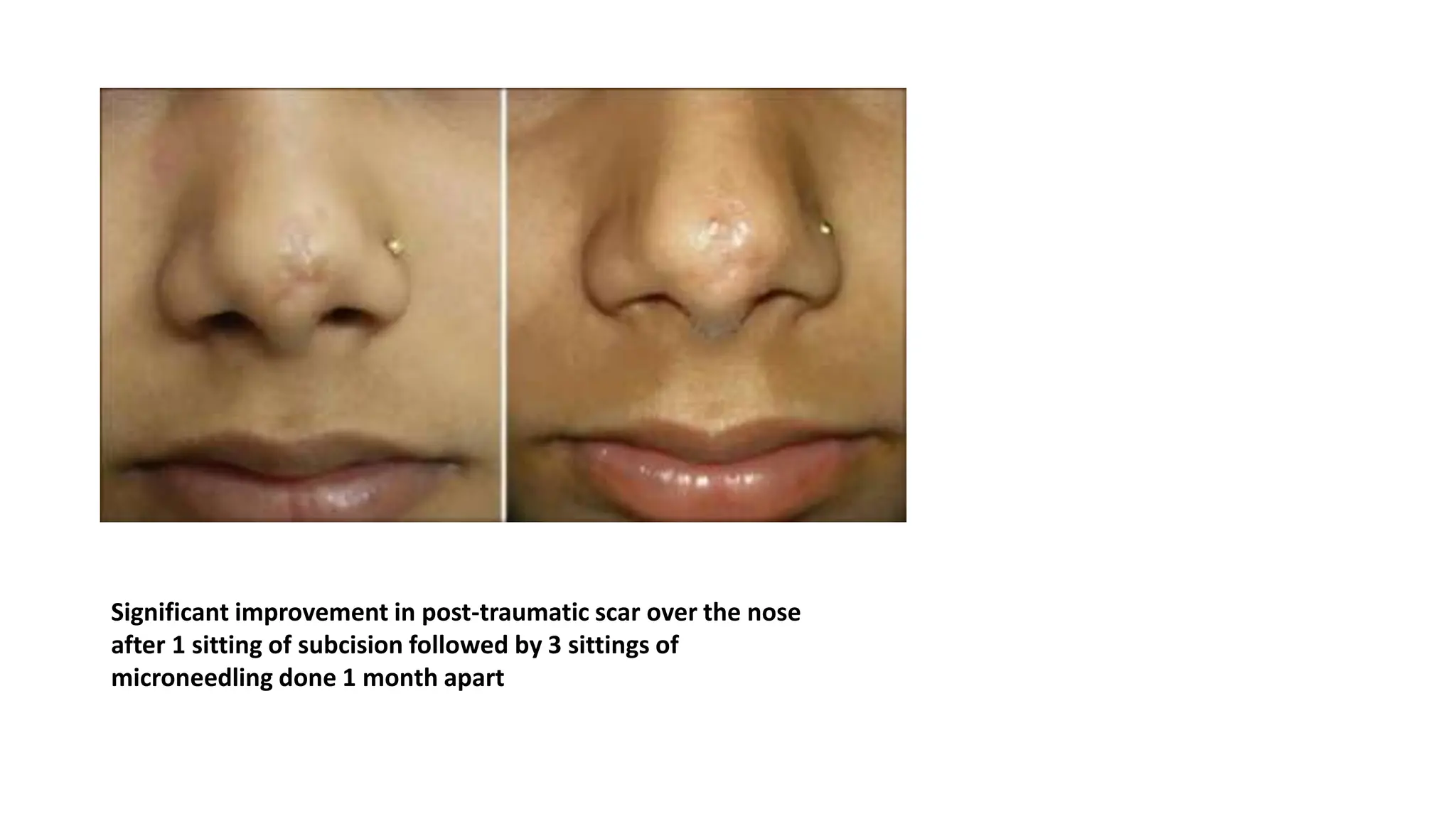 Microneedling a basic overview in derma.pptx