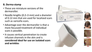 Microneedling advances and widening horizon .pptx