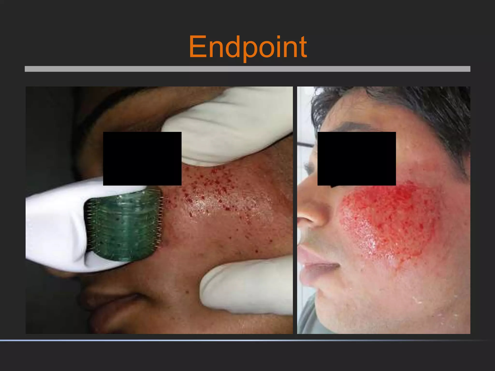 Microneedling & growth factors for acne scars | PPTX