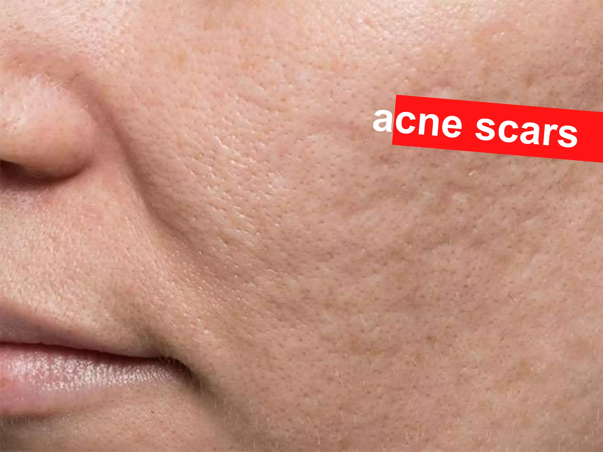 Microneedling & growth factors for acne scars | PPTX