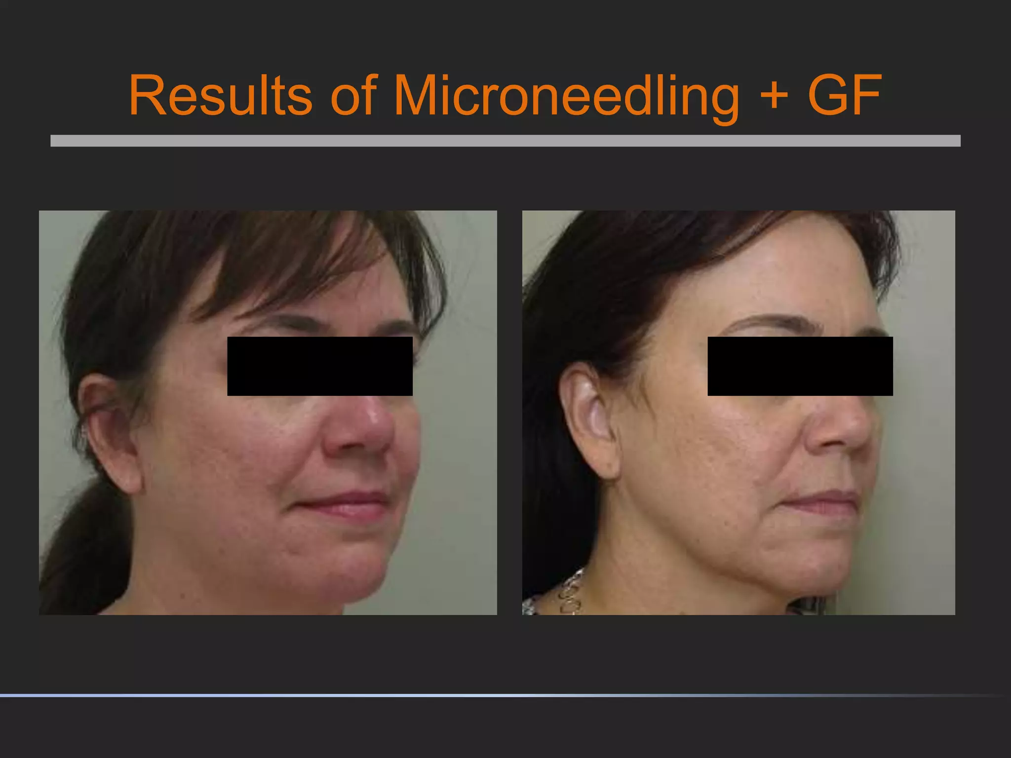 Microneedling & growth factors for acne scars | PPTX