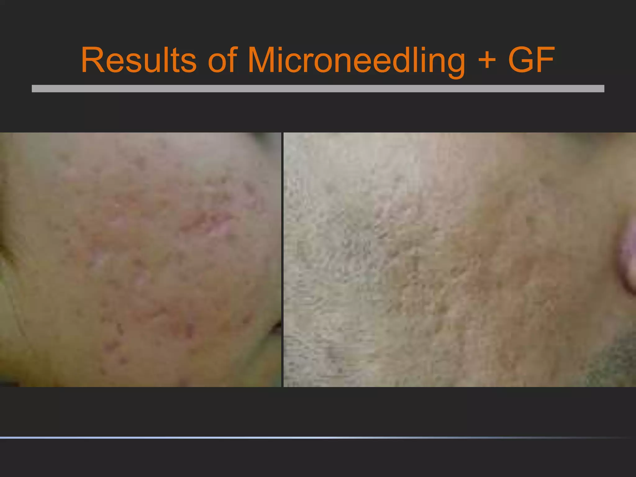 Microneedling & growth factors for acne scars | PPTX