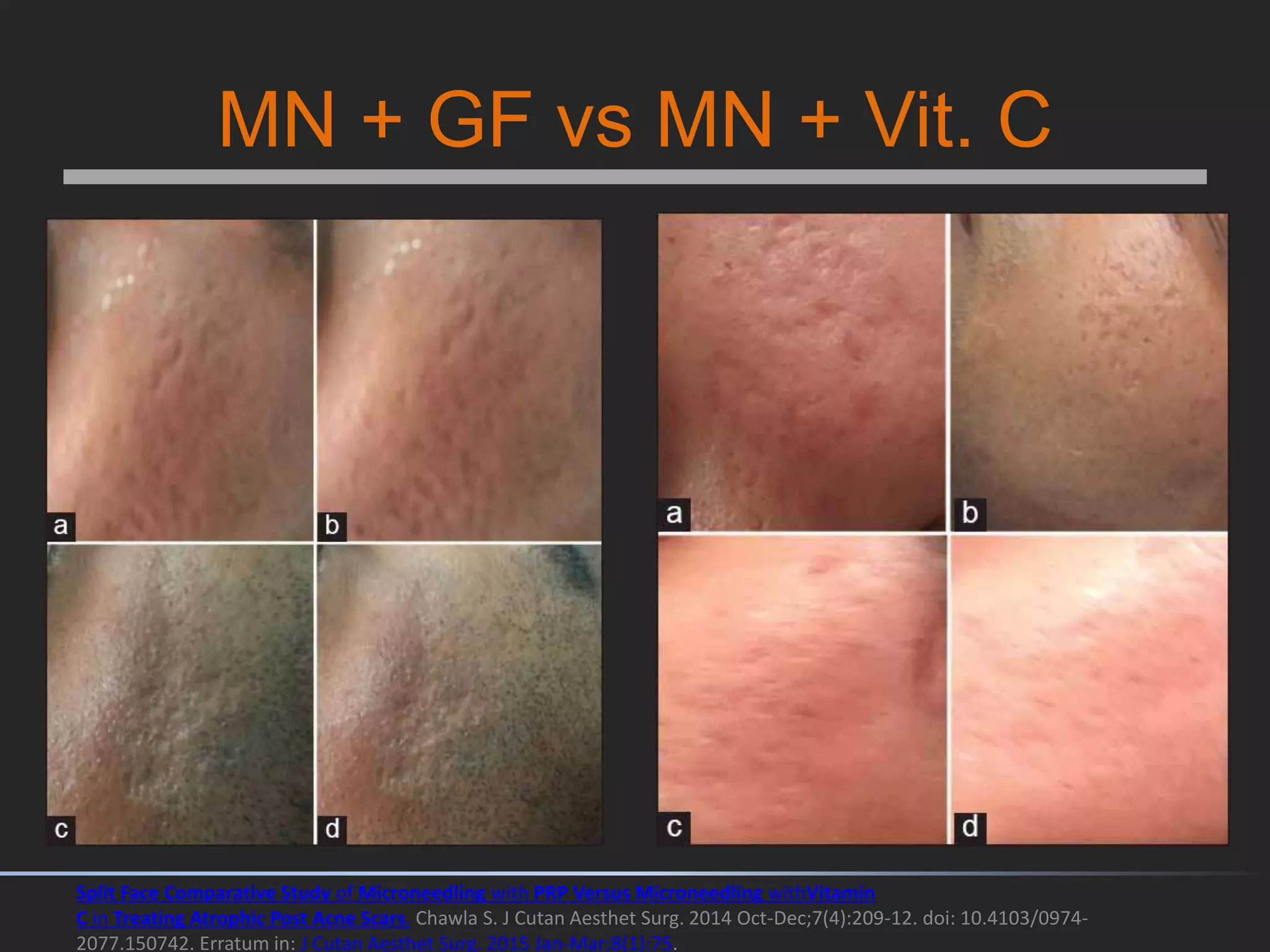 Microneedling & growth factors for acne scars | PPTX