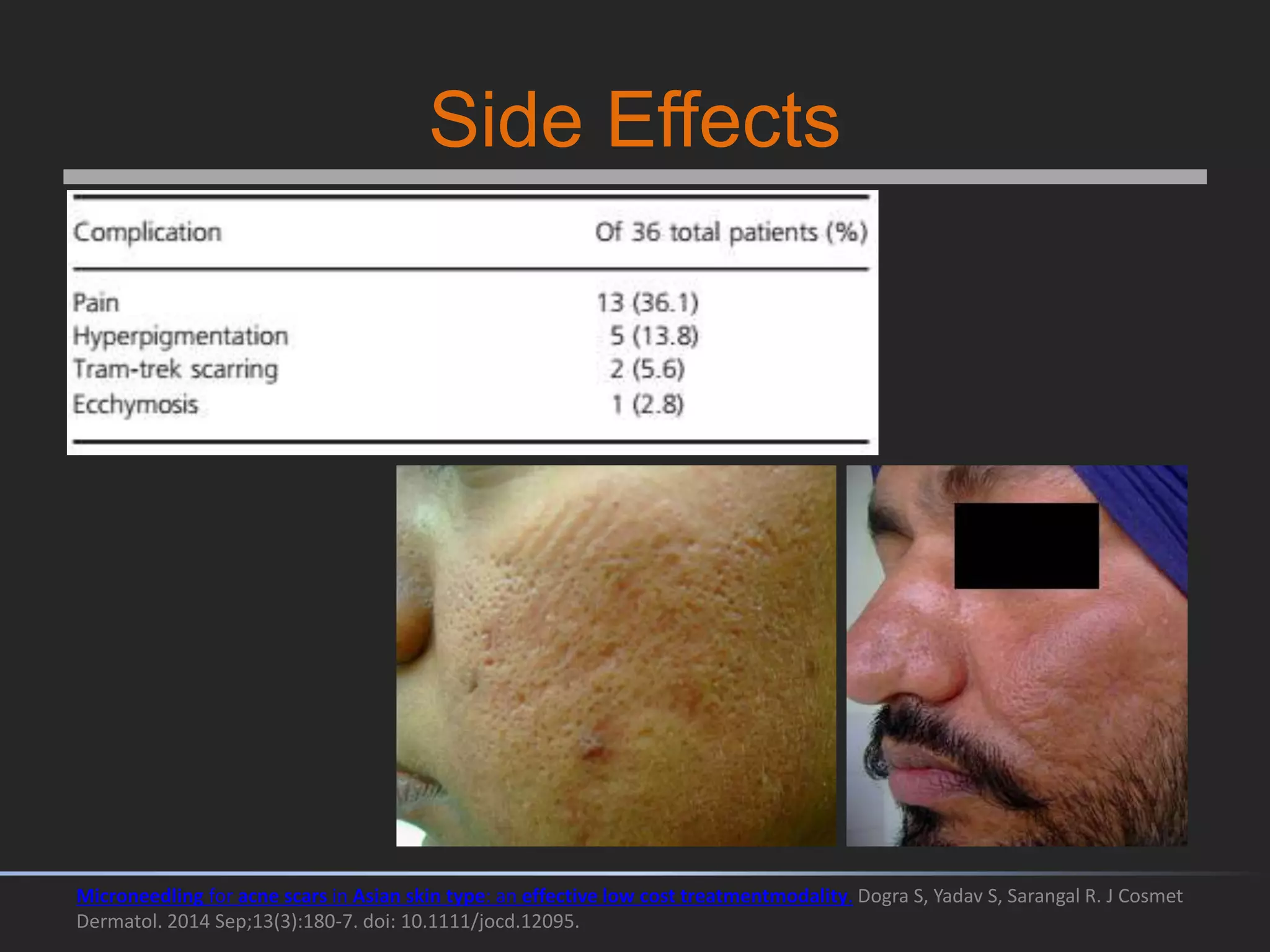 Microneedling & growth factors for acne scars | PPTX