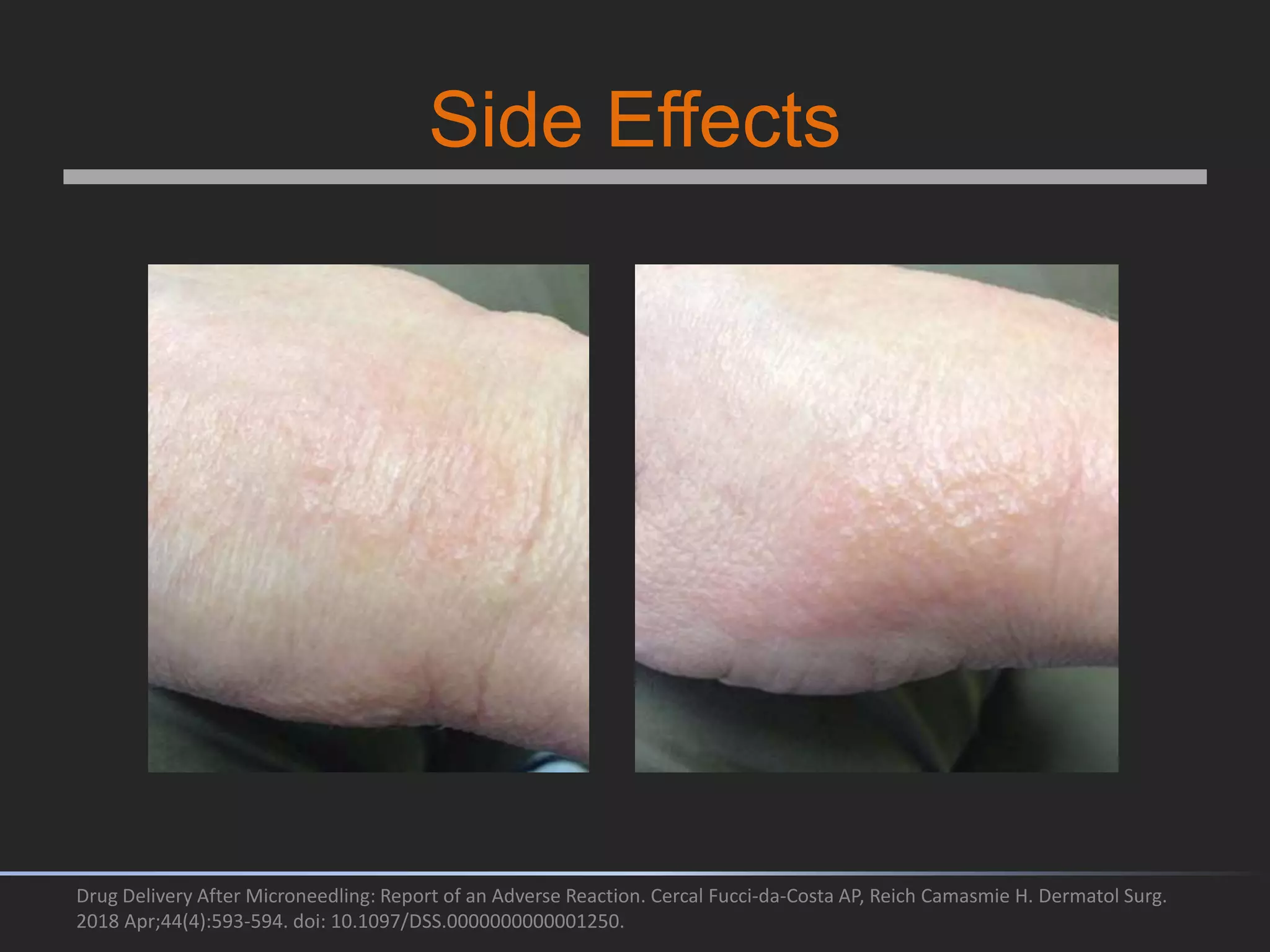 Microneedling & growth factors for acne scars | PPTX