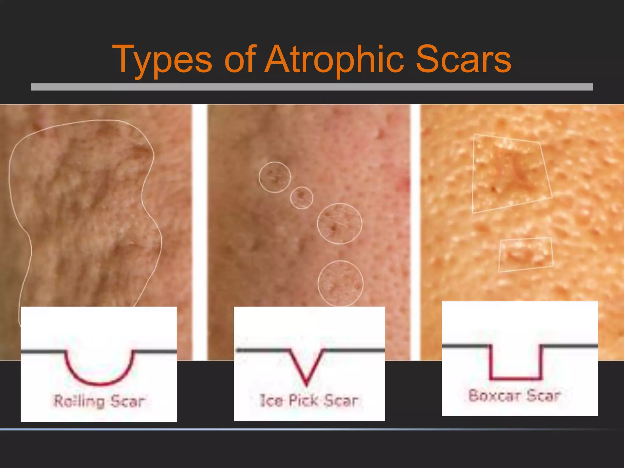 Microneedling & growth factors for acne scars | PPTX