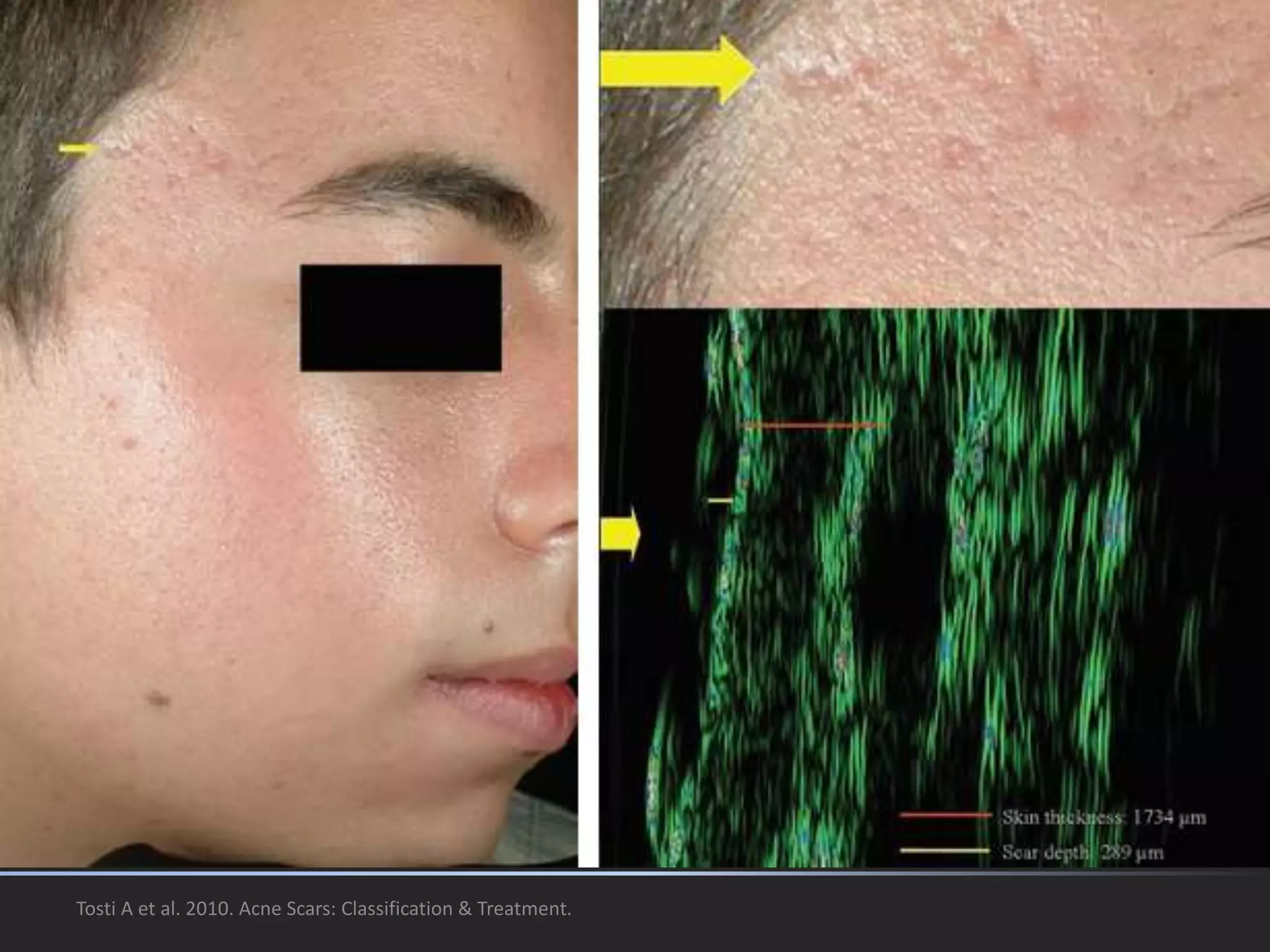 Microneedling & growth factors for acne scars | PPTX