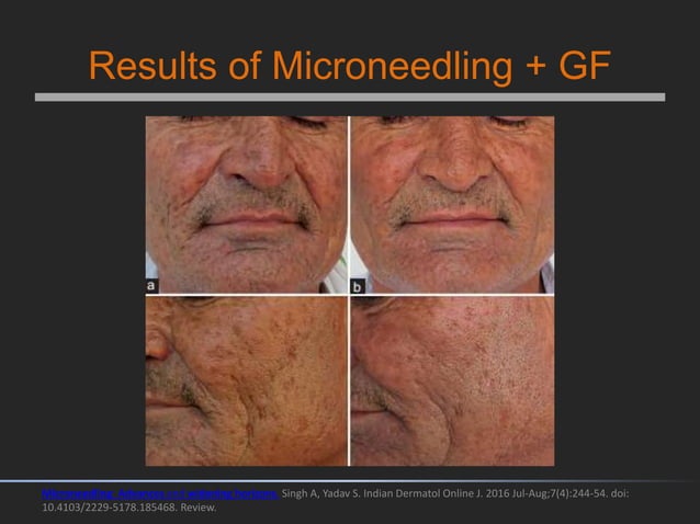 Microneedling & growth factors for acne scars | PPT