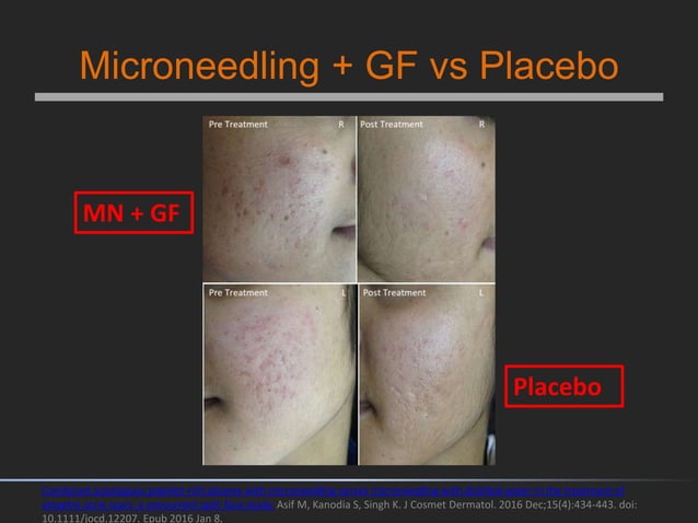 Microneedling & growth factors for acne scars | PPT