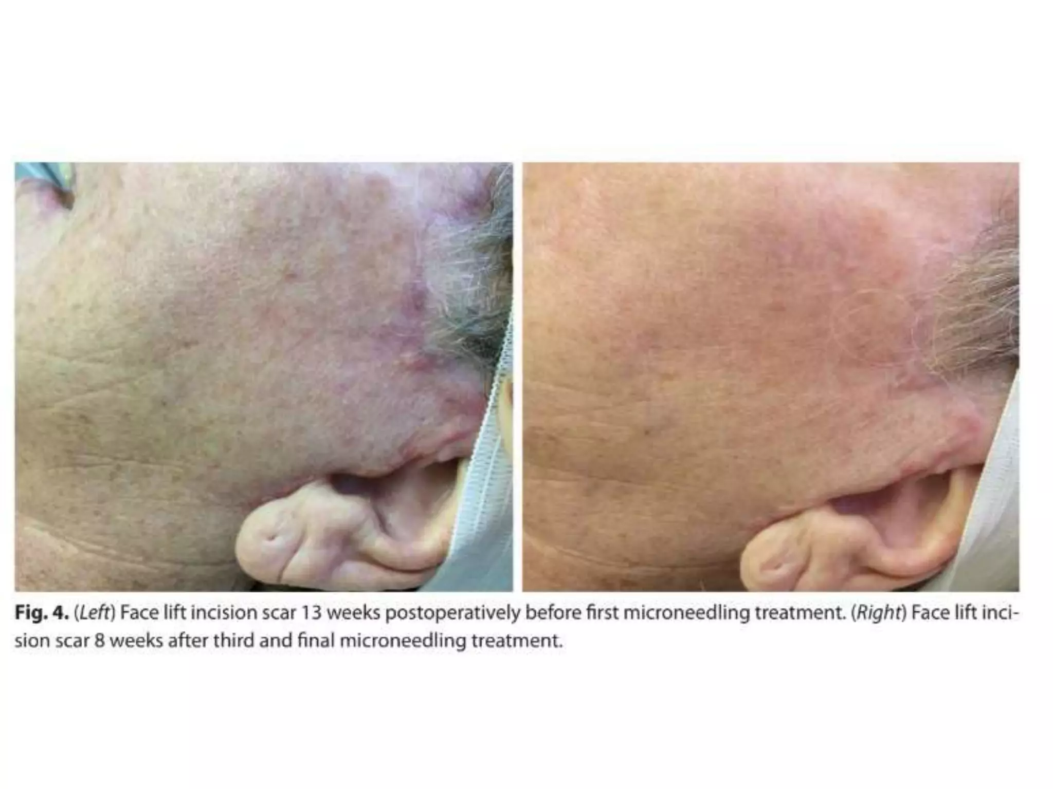 Microneedling Outcomes in Early Postsurgical Scar.pptx