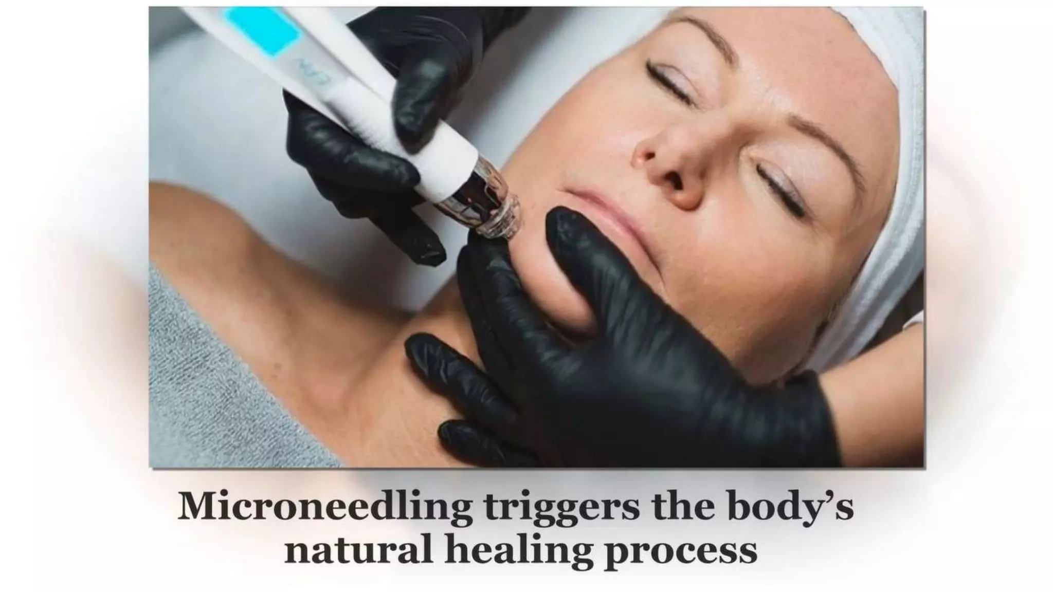 Microneedling To Treat Acne Scars | PPTX