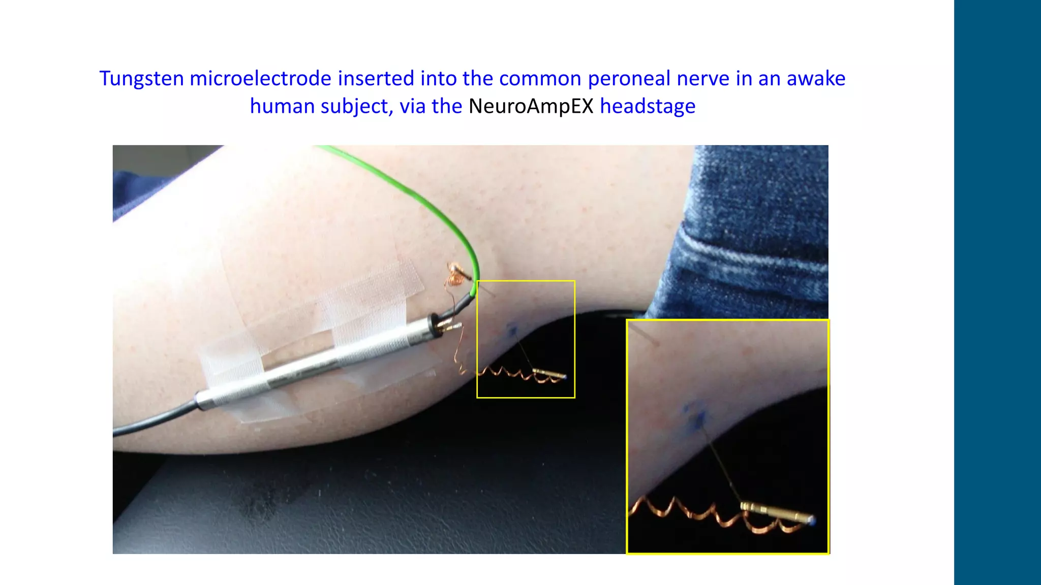 Microneurography: Recording Nerve Traffic Via Intraneural ...