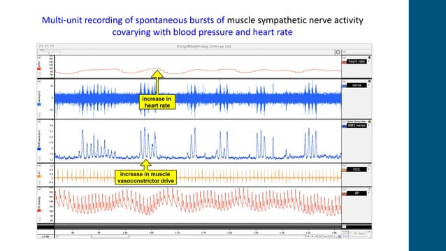 Microneurography: Recording Nerve Traffic Via Intraneural Microelectrodes in Awake Human ...