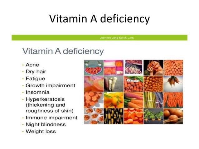 Micronutrient deficiency in pediatrics | PPTX | Infectious Diseases ...