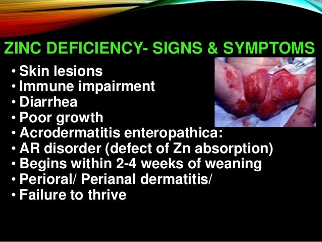 Zinc Deficiency Acrodermatitis Enteropathica