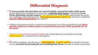 Micro phallus, Diagnosis and tretment.pptx