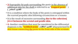 Micro phallus, Diagnosis and tretment.pptx