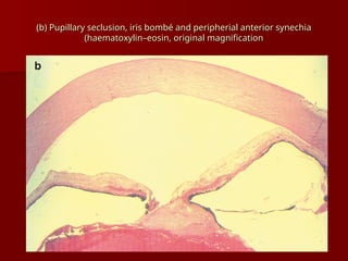 Microphthalmos and Nanophthalmos - eyerounds.org.ppt
