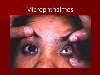 Microphthalmos and Nanophthalmos - eyerounds.org.ppt