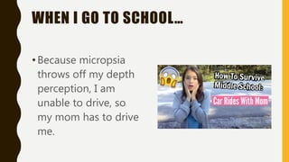 Micropsia | PPTX