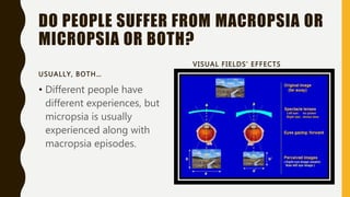 Micropsia | PPT