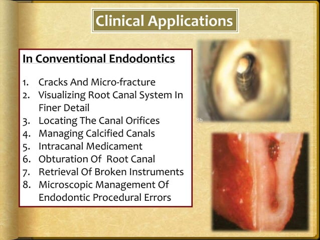 Operating Microscope in Endodontics | PPTX