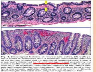 Microscopic colitis | PPTX | Digestive Disorders | Diseases and Conditions