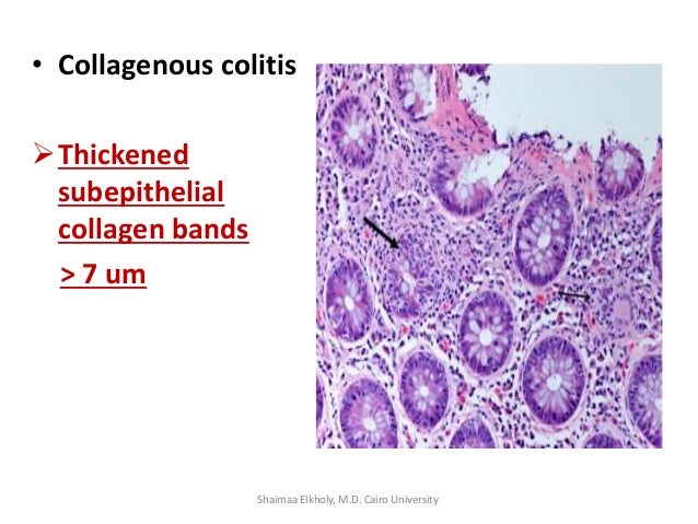 Microscopic colitis