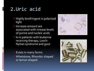 Polarized Uric Acid Crystals In Urine