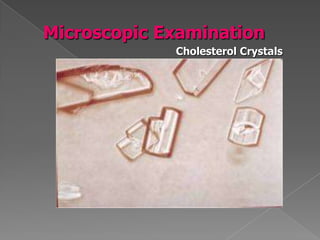 Cholesterol Crystals In Urine