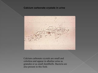 Calcium Carbonate Crystals In Urine