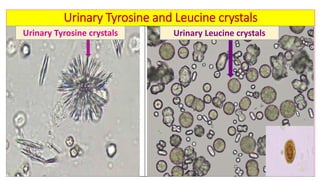 Bilirubin Crystal In Urine