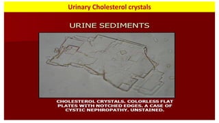 Cholesterol Crystals In Urine