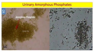 Amorphous Phosphate Crystals In Urine