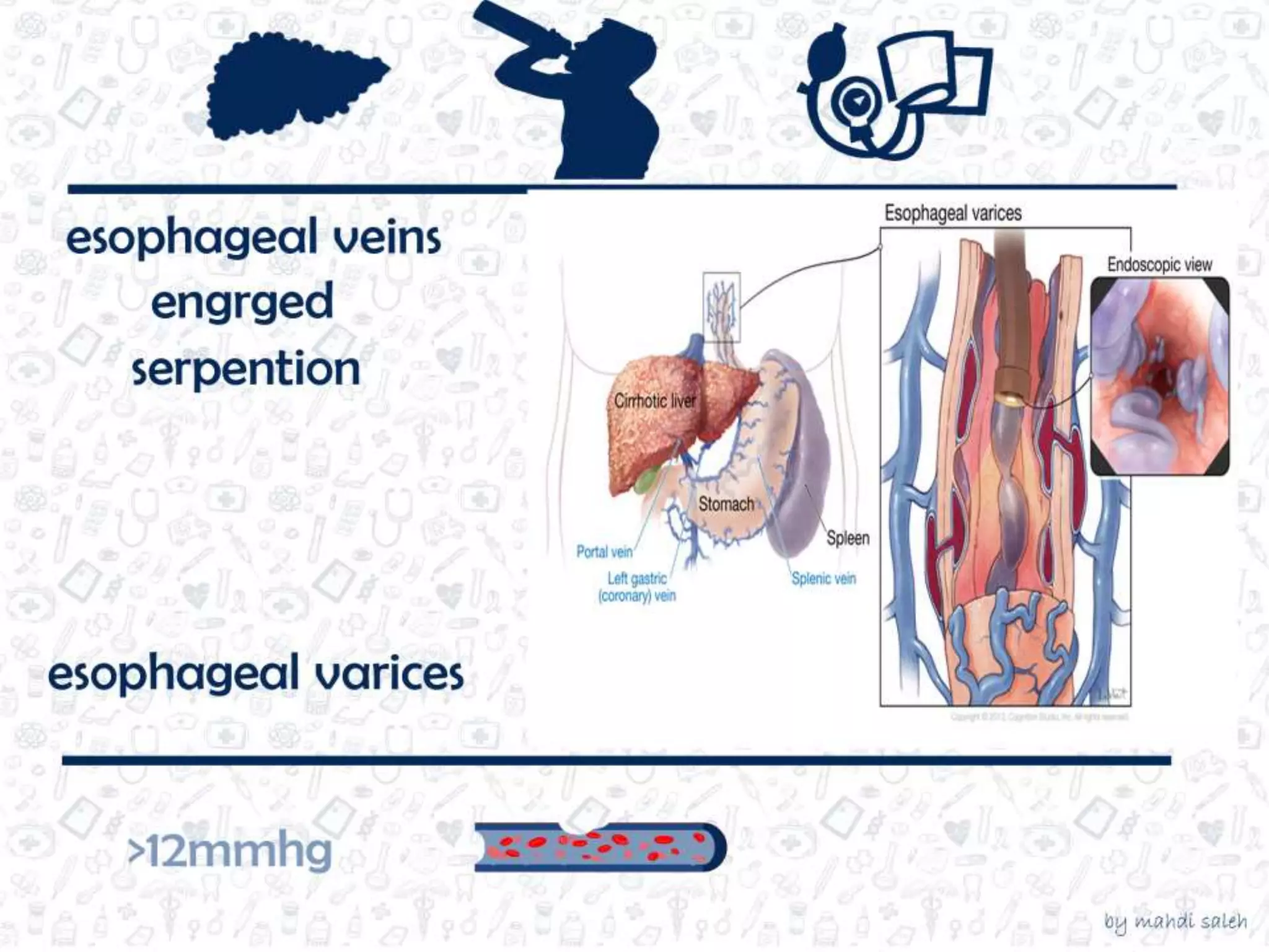 esophageal varices | PPT