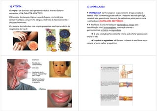 Reaes De Hipersensibilidades e Alergias - Imunologia | PDF