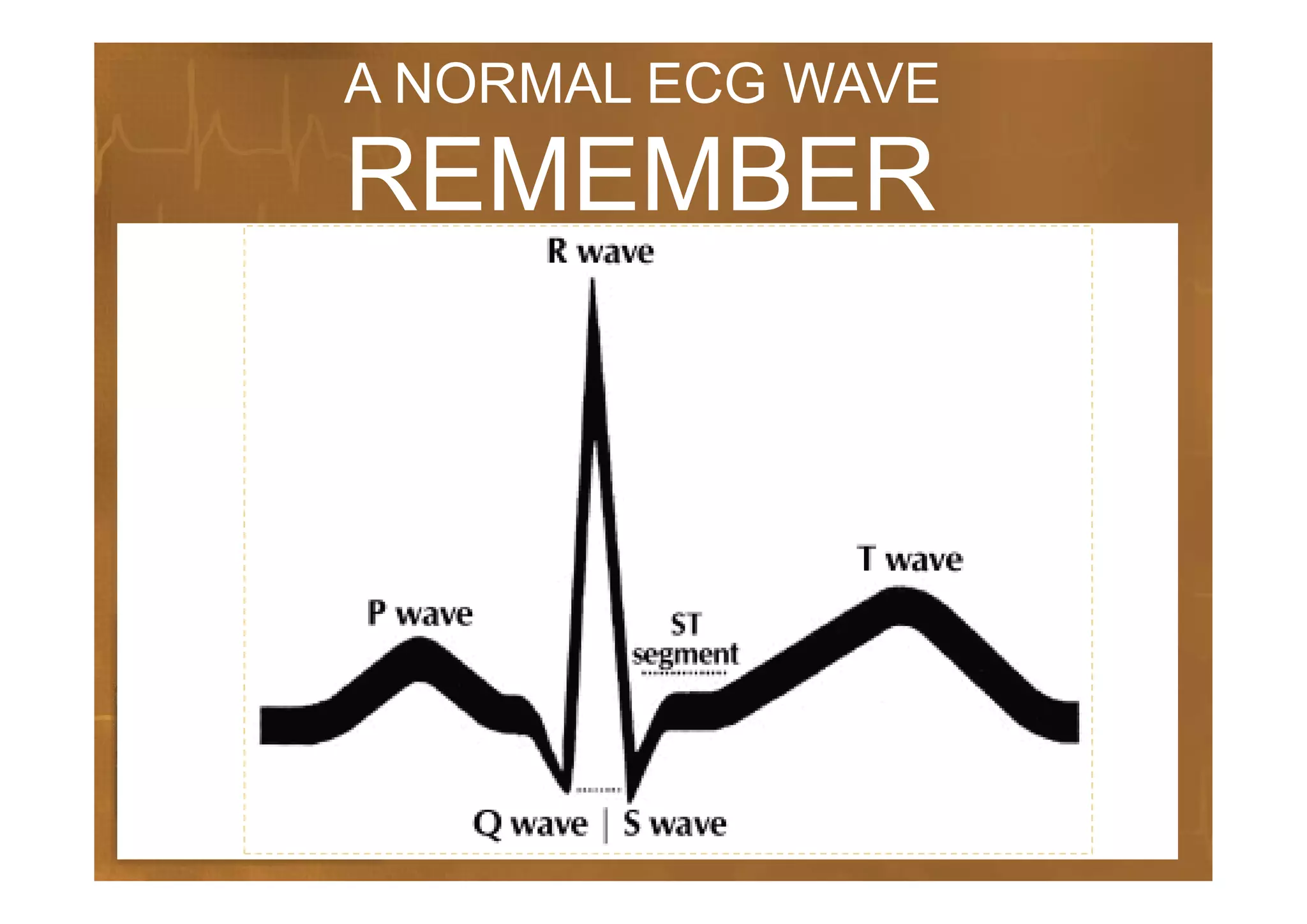 Basics of ECG | PDF