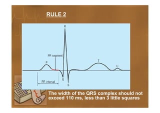 Basics of ECG | PDF