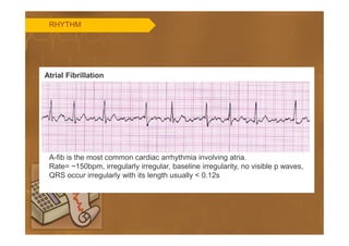 Basics of ECG | PDF